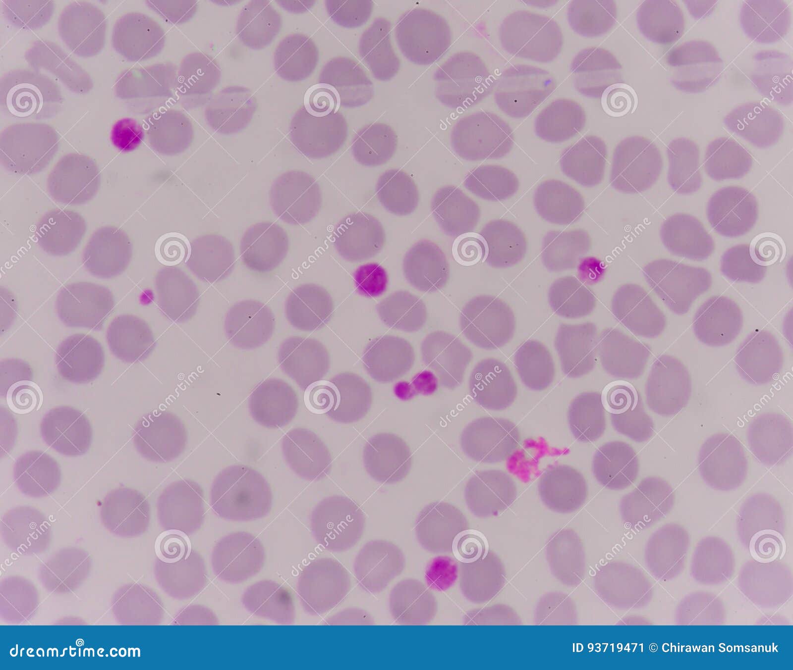 Giant Platlet on Red Blood Cells Stock Image - Image of illness, slides ...