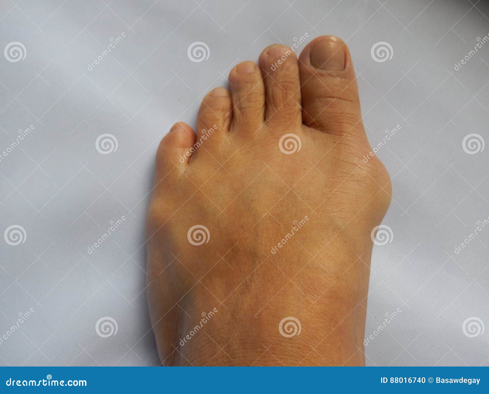 Gikt arkivfoto. Bild av gikt, produkter, belopp, skallr - 88016740