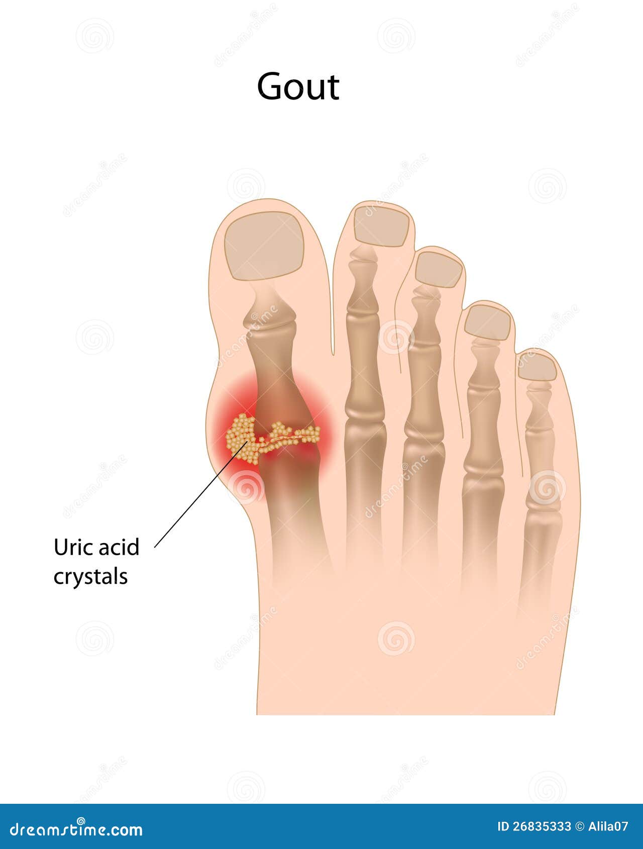 Gikt av stortån vektor illustrationer. Illustration av giktbrutet ...