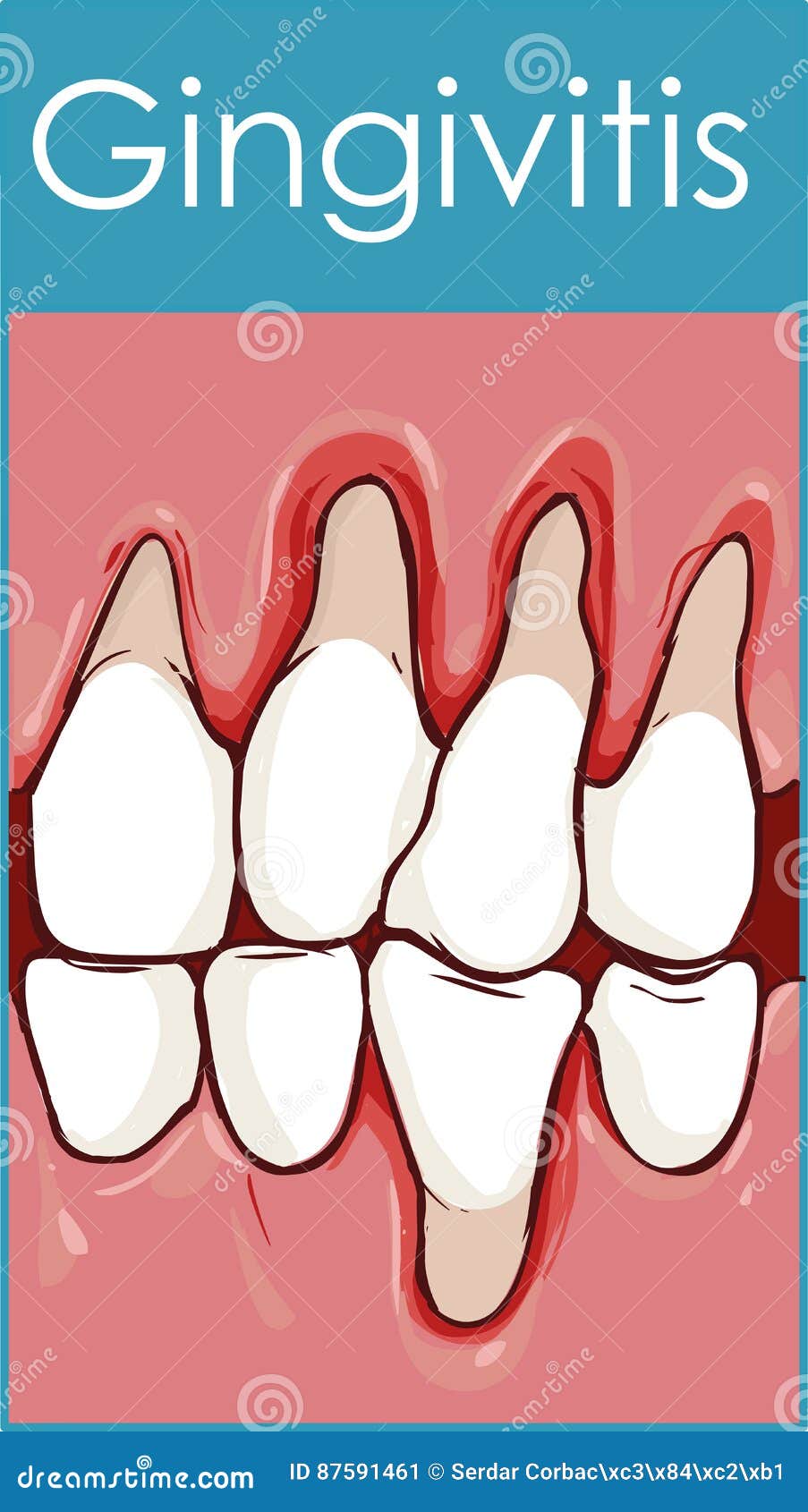 Gingivitis Ilustraciones Stock, Vectores, Y Clipart – (492 ...