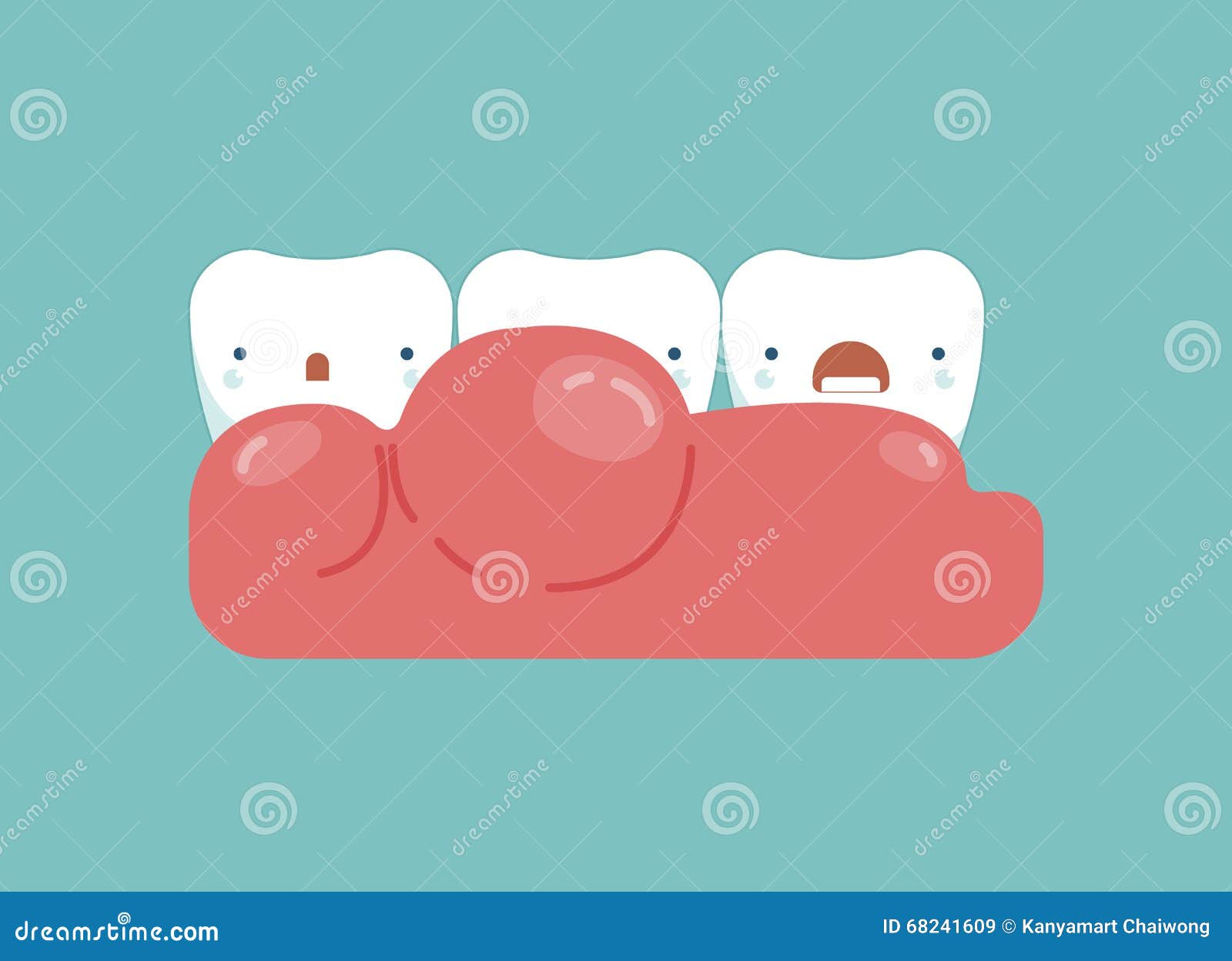 Gingivitis Around The Teeth ,dental Concept Cartoon Vector ...