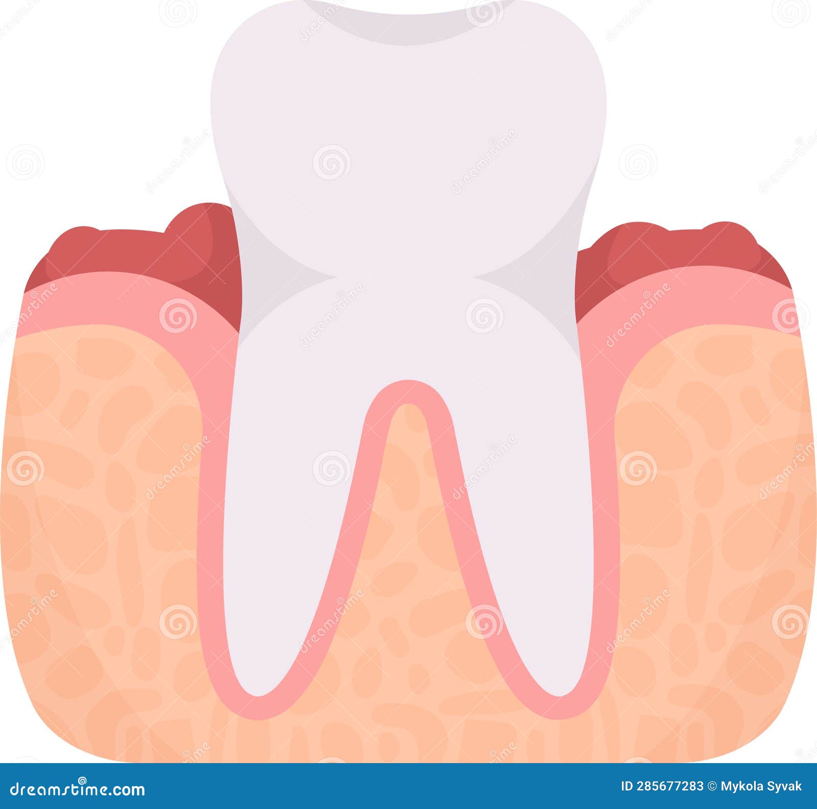 Gingivitis Tooth Problem stock vector. Illustration of treatment ...