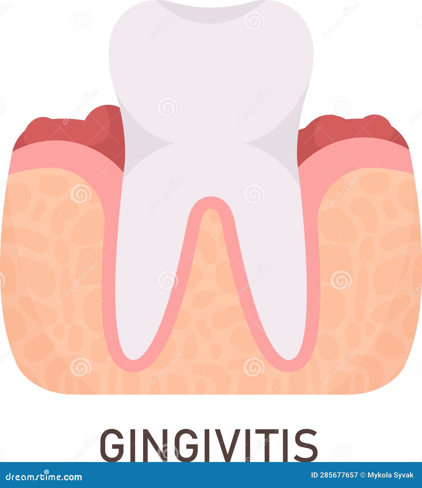 Gingivitis Tooth And Gums. Plaque And Calculus Build Up Gums And ...