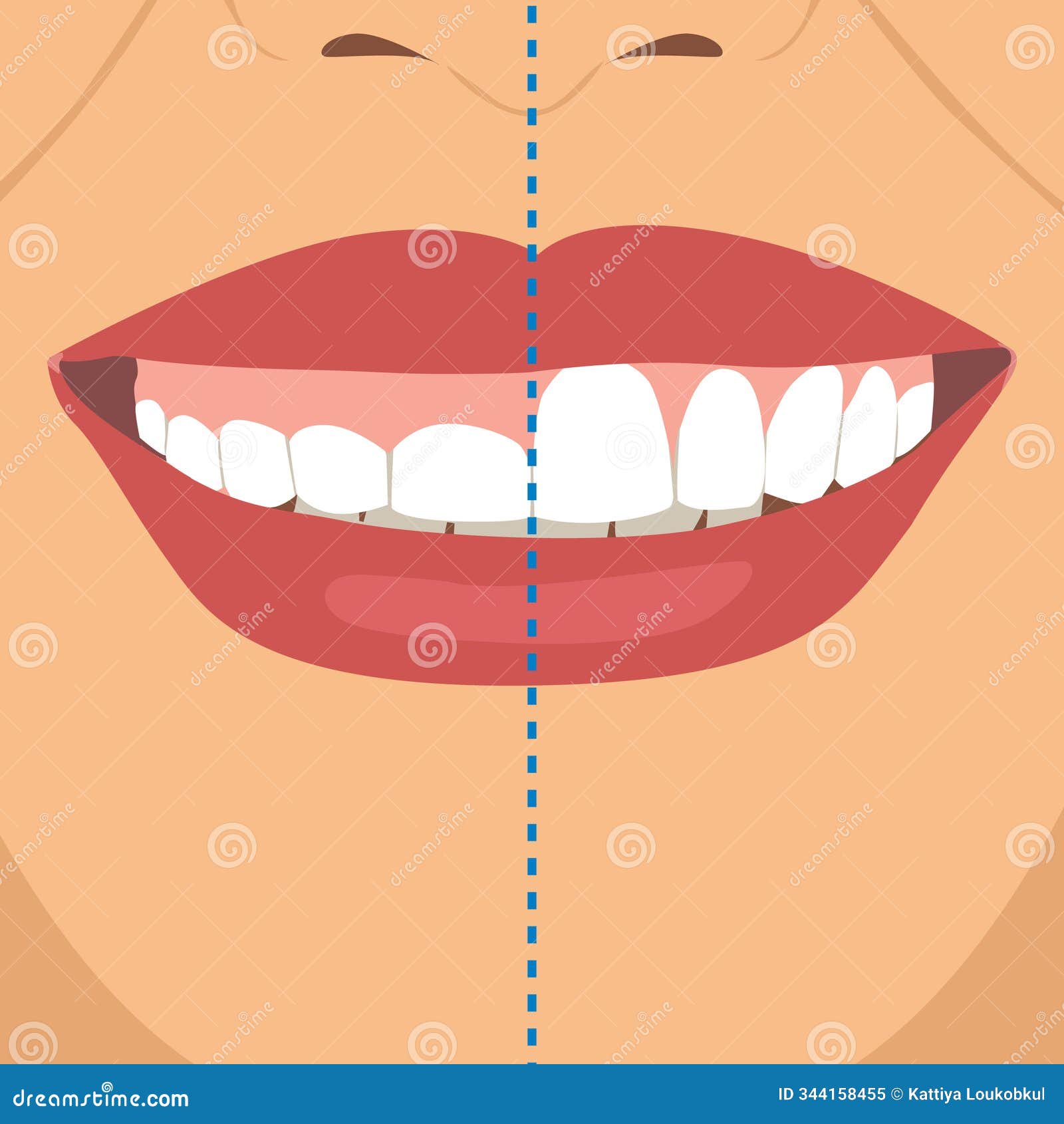 Gingivoplasty Cut Gum Surgery Off Compare Upper Teeth, Illustration ...