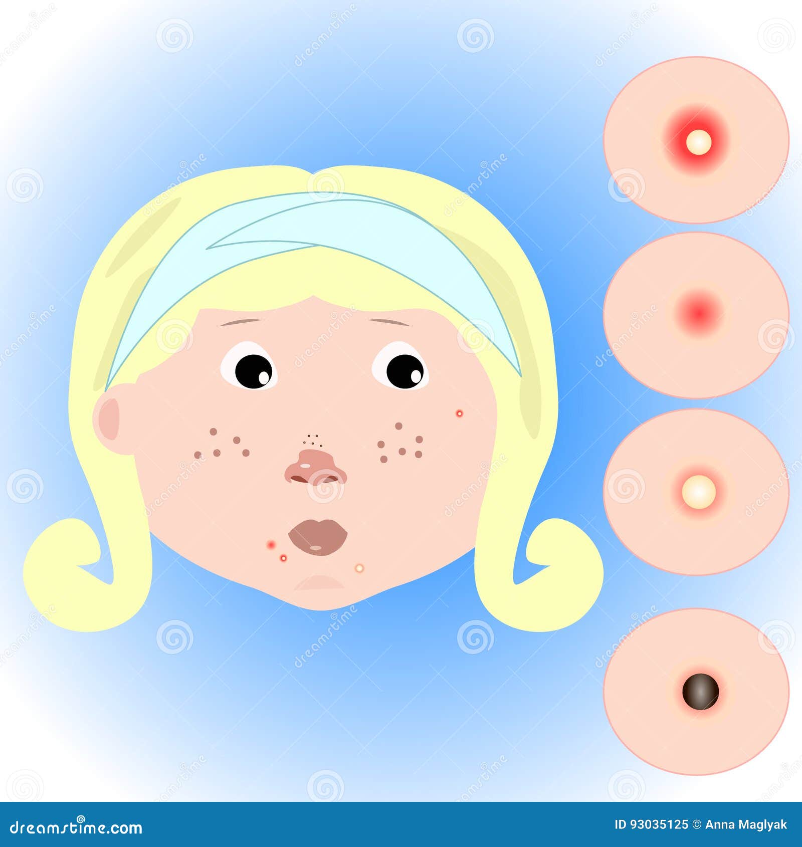 Girl with acne problems stock vector. Illustration of blackhead - 93035125