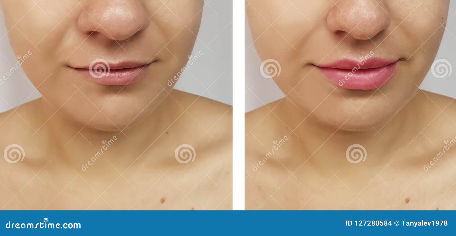 Girl Lips Increase before and after Stock Photo - Image of perfect ...