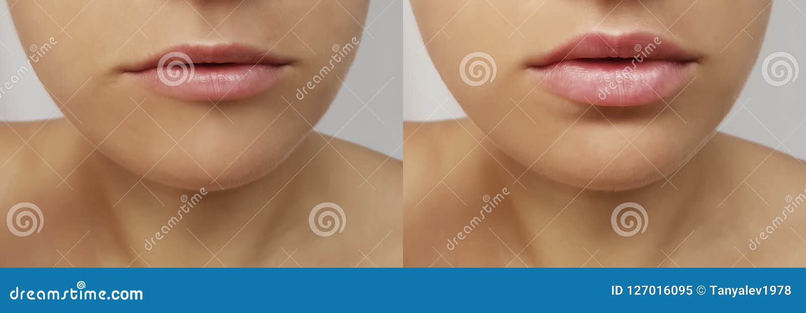 Girl Lips, Syringe Injection, Lip Augmentation Correction before and ... Girl Lips, Syringe Injection, Lip Augmentation Correction before and ...