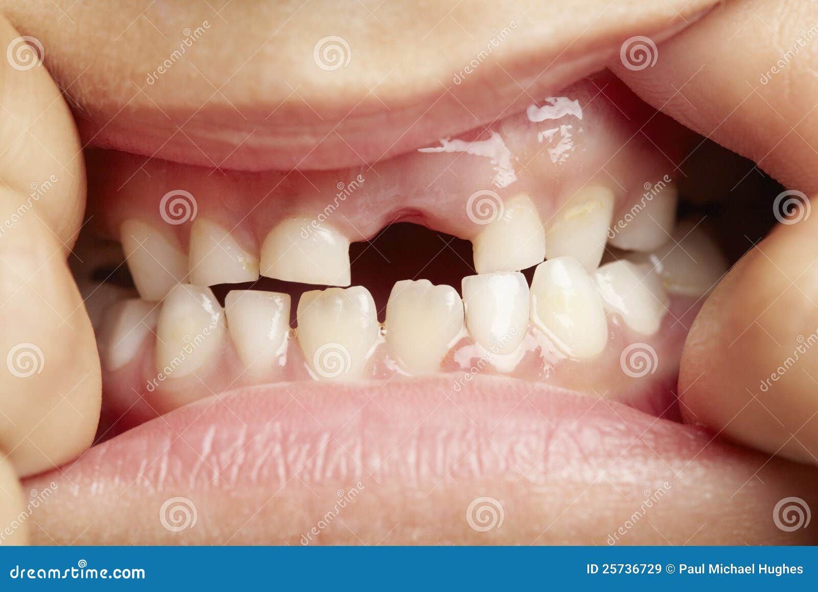 Girl with Missing Front Tooth Stock Image - Image of little, expressive ...