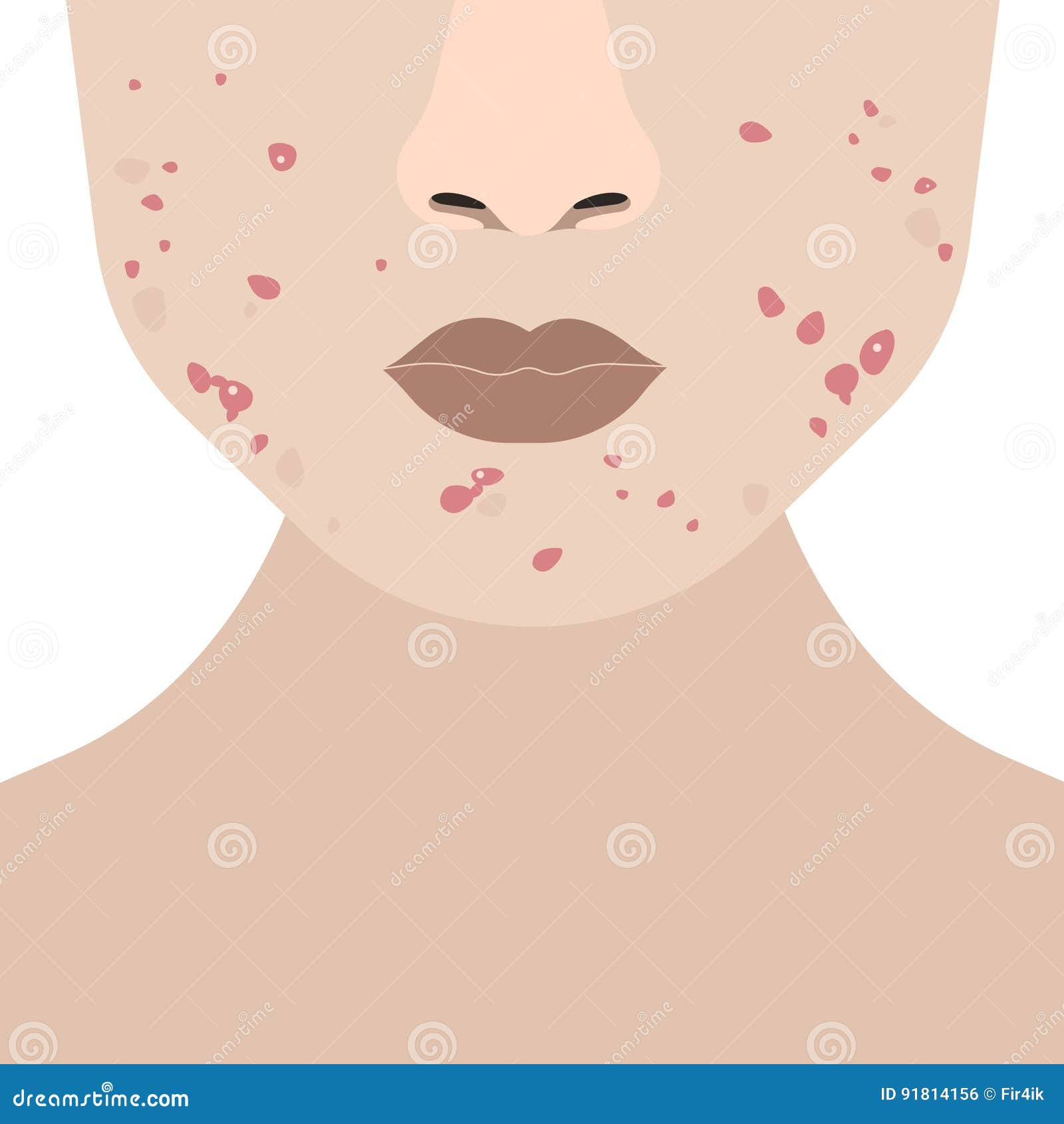 Girl with problematic skin stock vector. Illustration of facial - 91814156