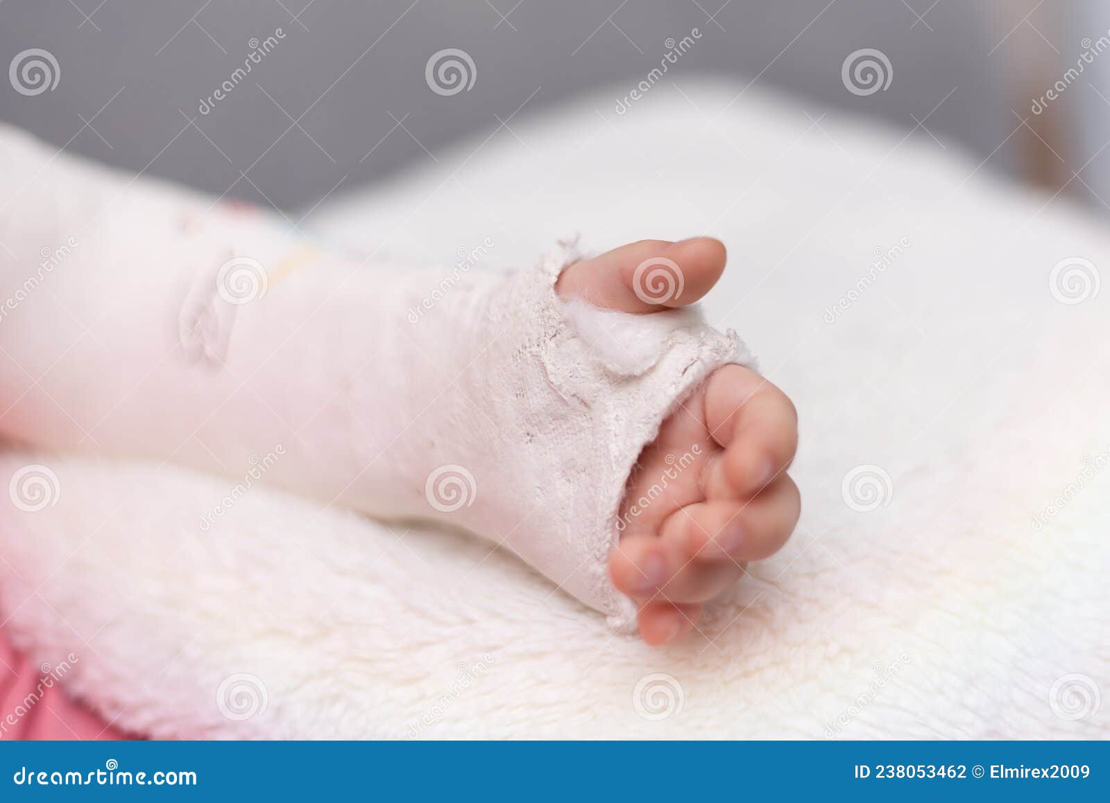 Girl`s Broken Left Arm Has Drawn a Cute Image on Her Arm on the Plaster ...