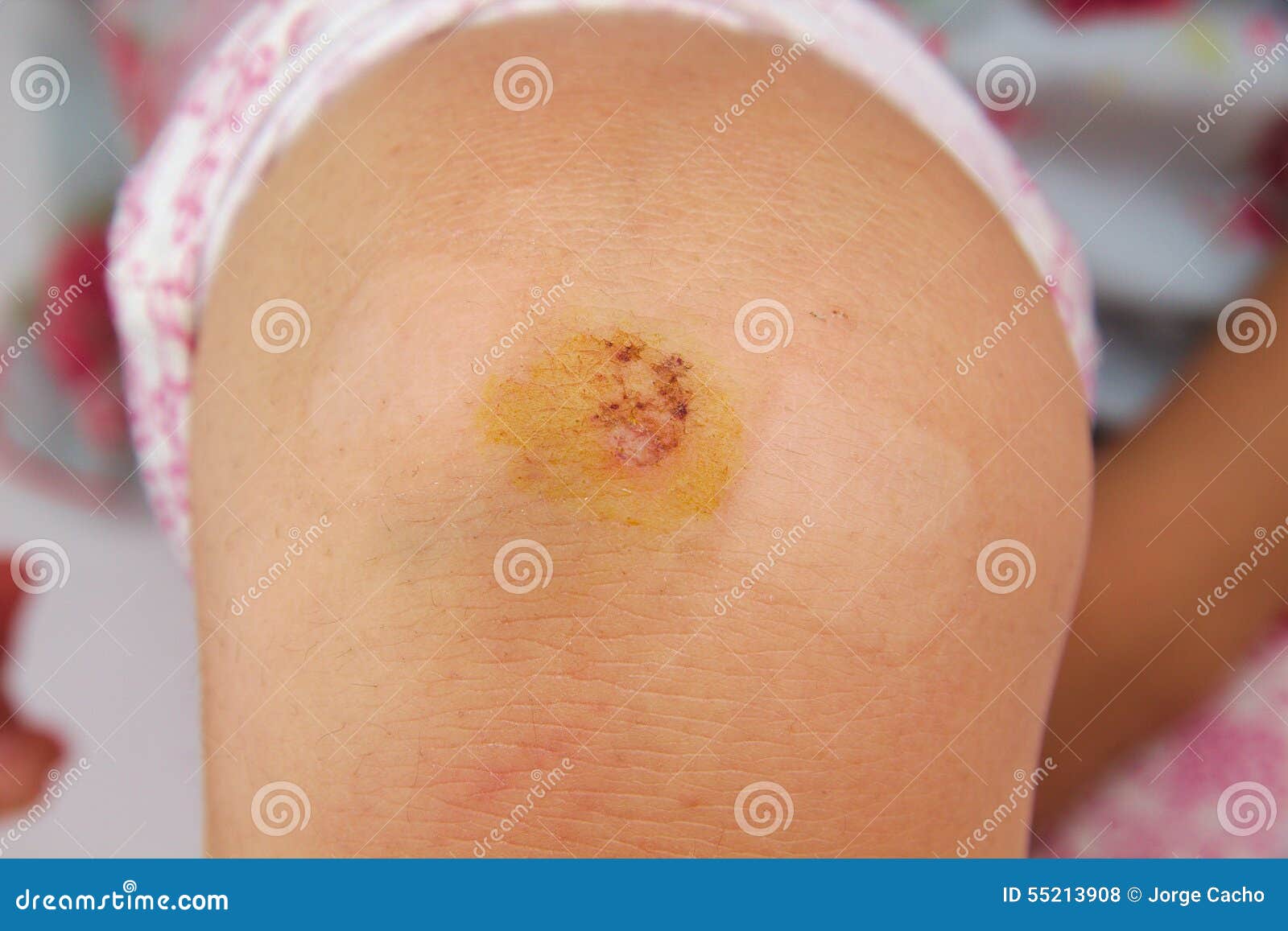 Girl with a Scraped Knee. Wound Concept Stock Photo - Image of ouch ...