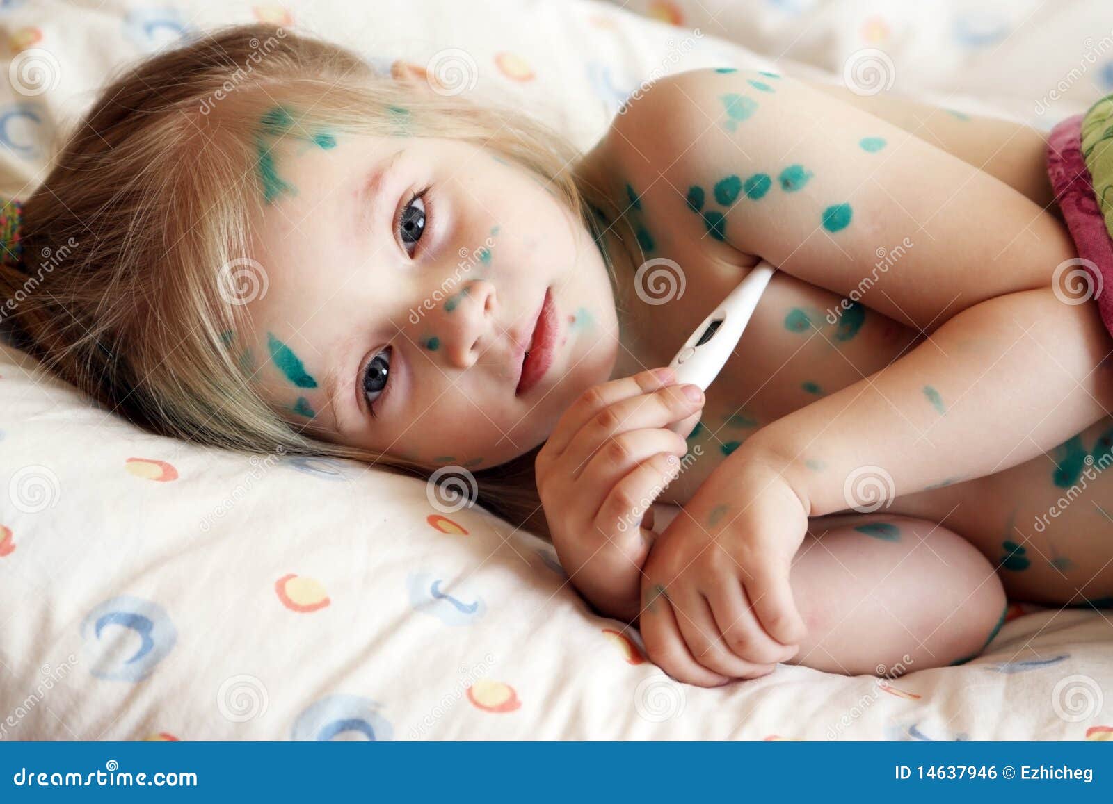Girl Suffers Chickenpox Stock Photos - Free & Royalty-Free Stock Photos ...