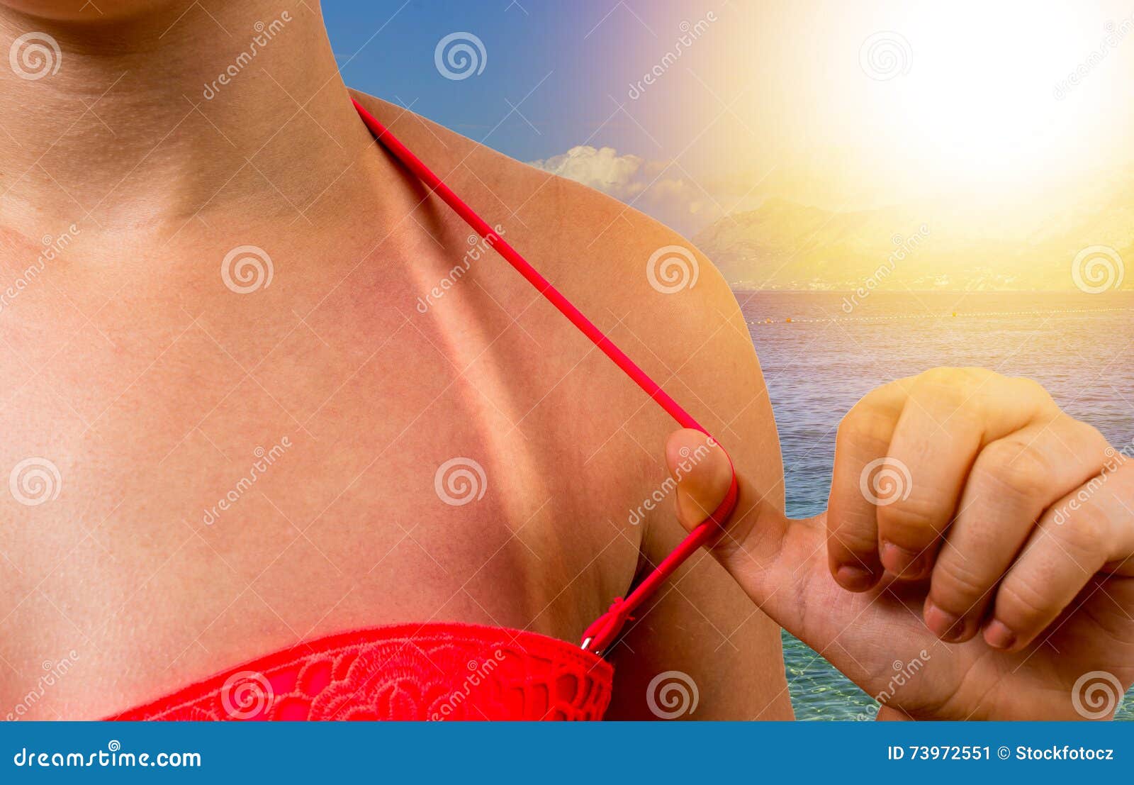Sunburned Skin On Shoulder And Back Of A Woman Red Skin Sun Burn After
