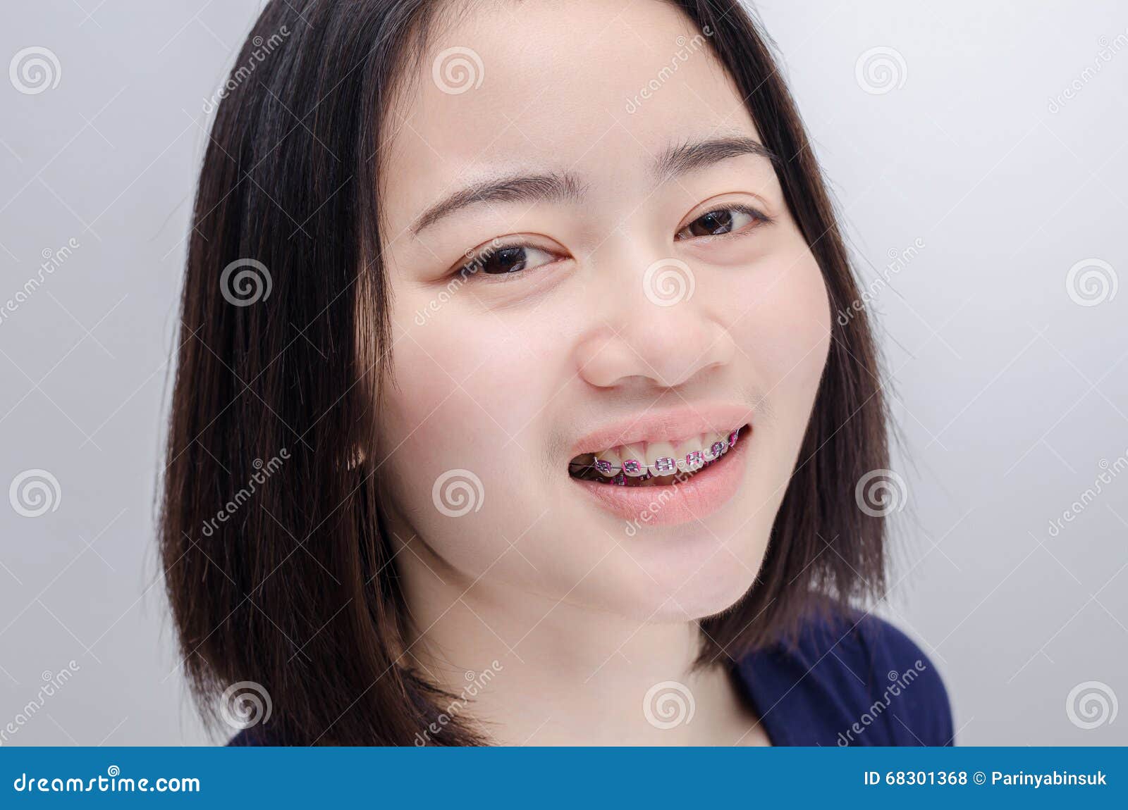 Girl with teeth brace stock photo. Image of healthy, background - 68301368