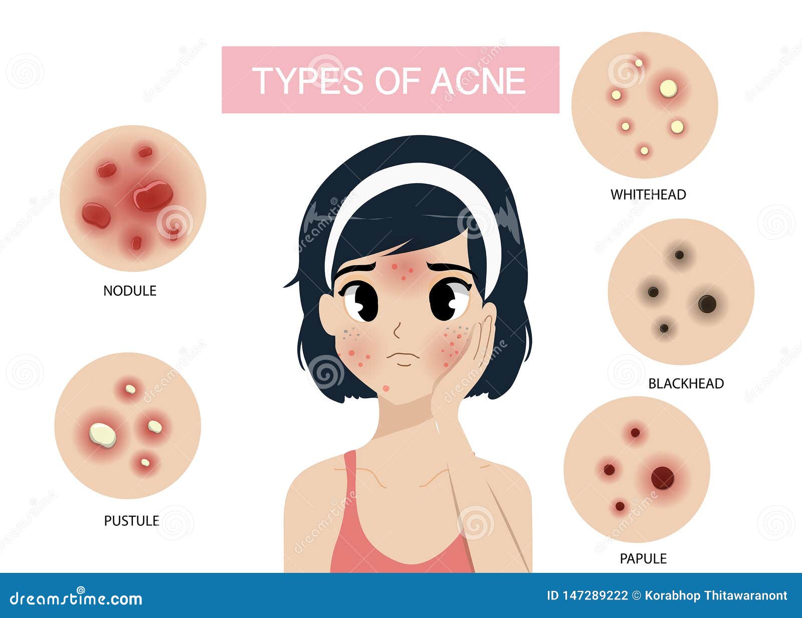 Types Of Acne Pimples Cartoon Vector | CartoonDealer.com #101722023