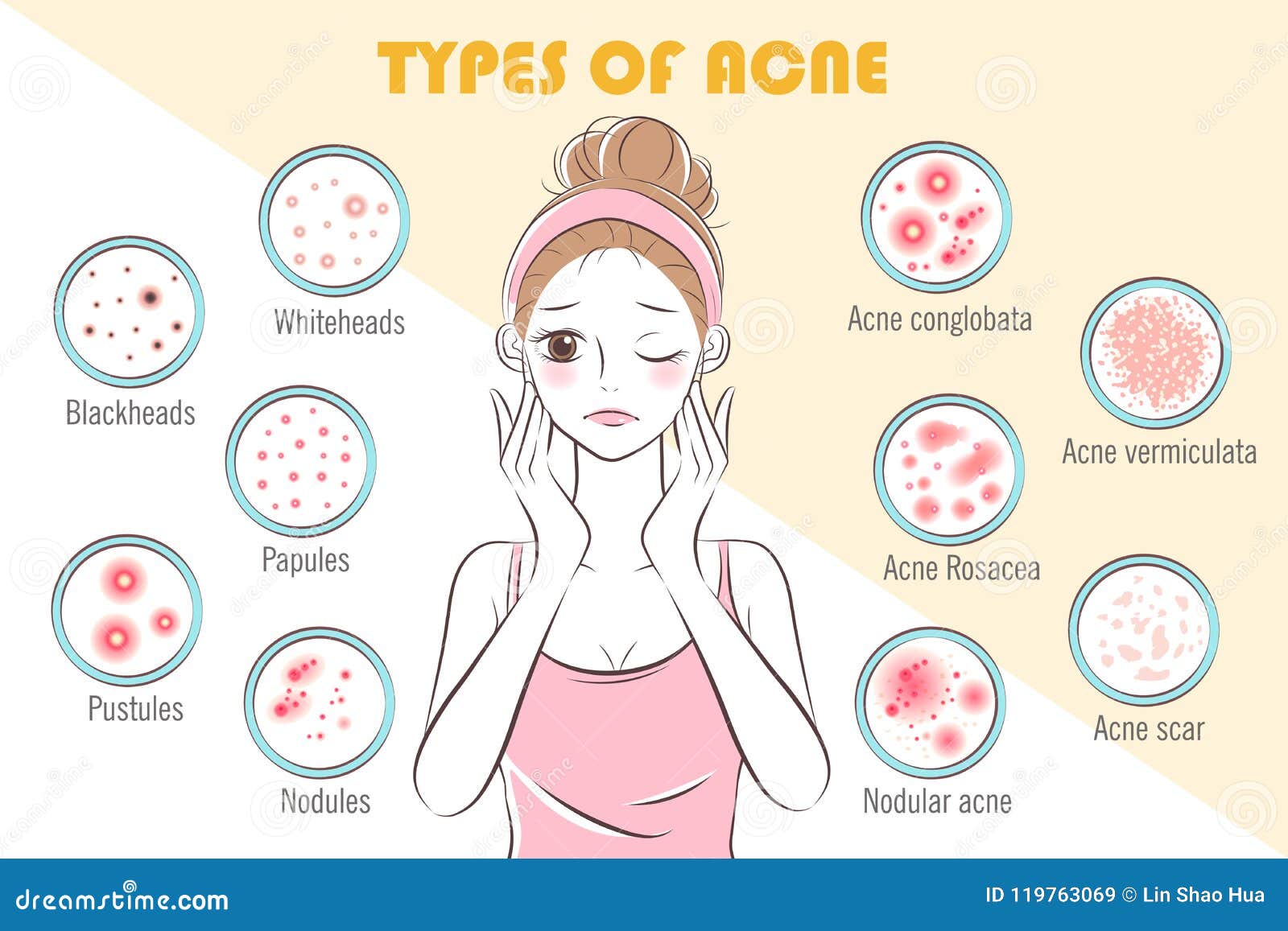 Types Of Acne Diagram Illustration Vector On White Background B