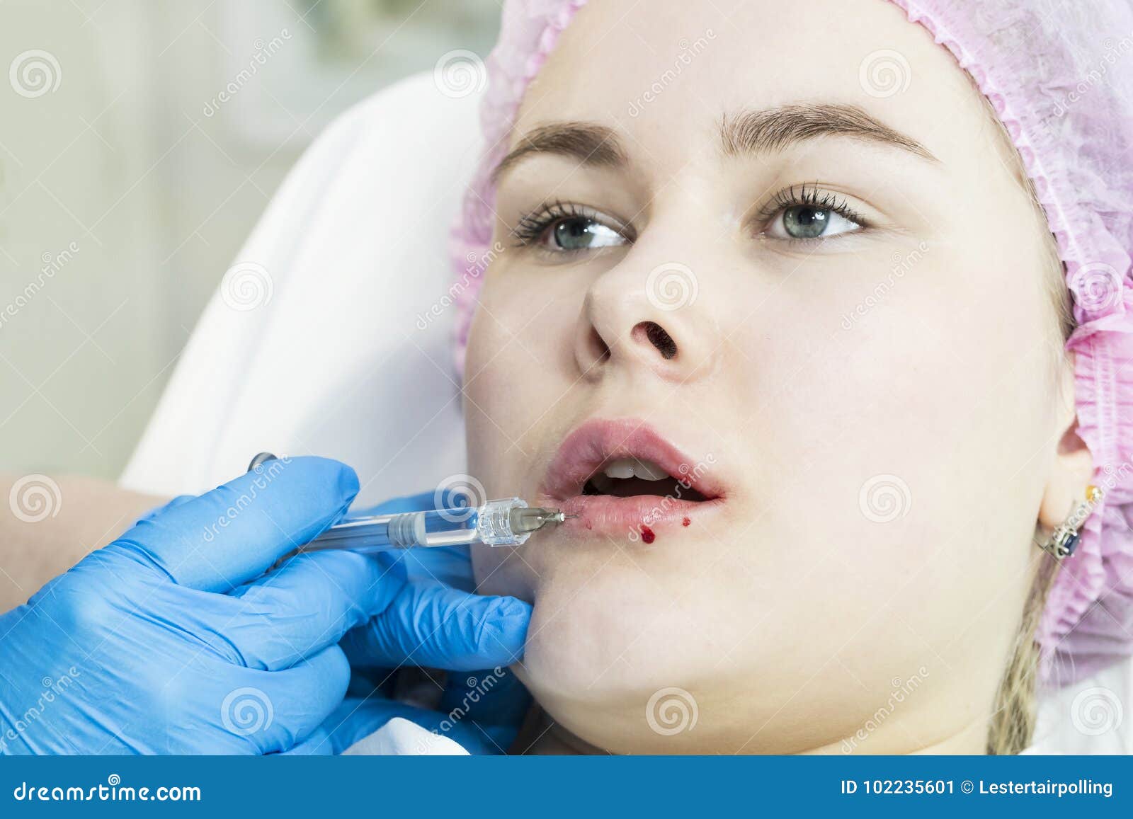 Girl Undergoes The Procedure Of Cosmetic Surgery To Increase The Lips