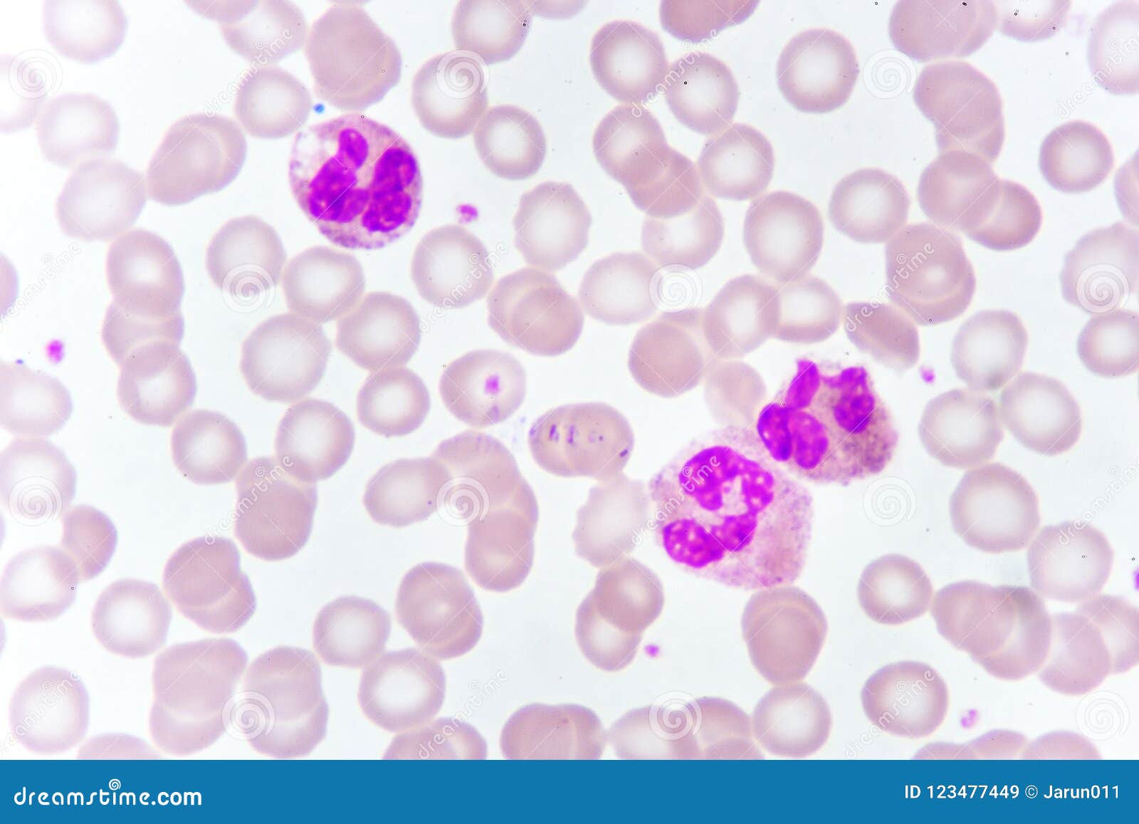 Glóbulo Blanco En Mancha De La Sangre Imagen de archivo - Imagen de ...