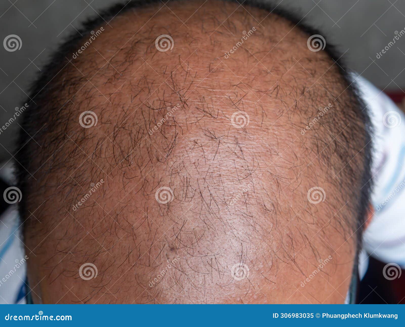 Glabrous on Male Bald Head . Stock Image - Image of hairline, male ...