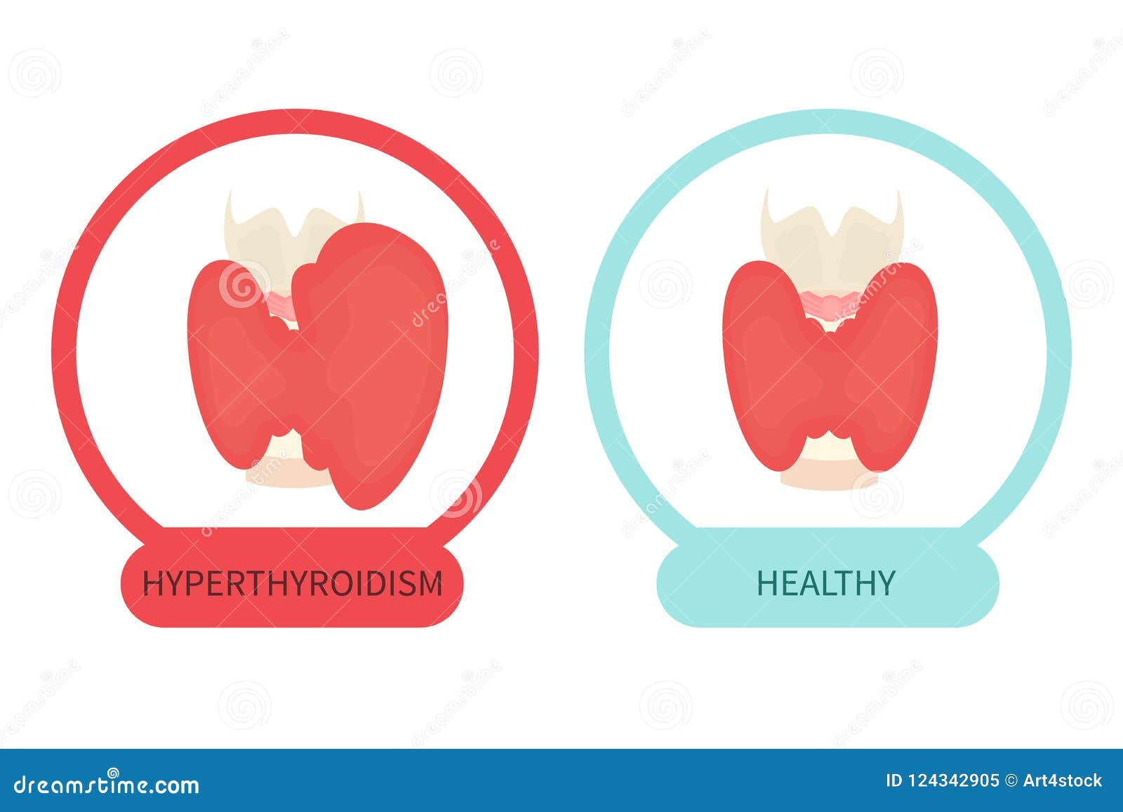 Gland With Healthy Thyroid And Hyperthyroid Disorder Cartoon Vector ... Gland With Healthy Thyroid And Hyperthyroid Disorder Cartoon Vector ...