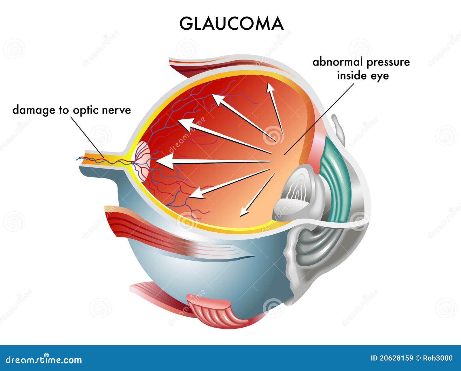 Glaucoma stock vector. Illustration of ophthalmology - 20628159