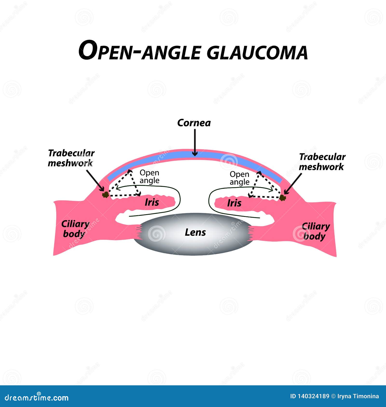 Glaucoma De ángulo Abierto Un Tipo Común De Glaucoma La Estructura