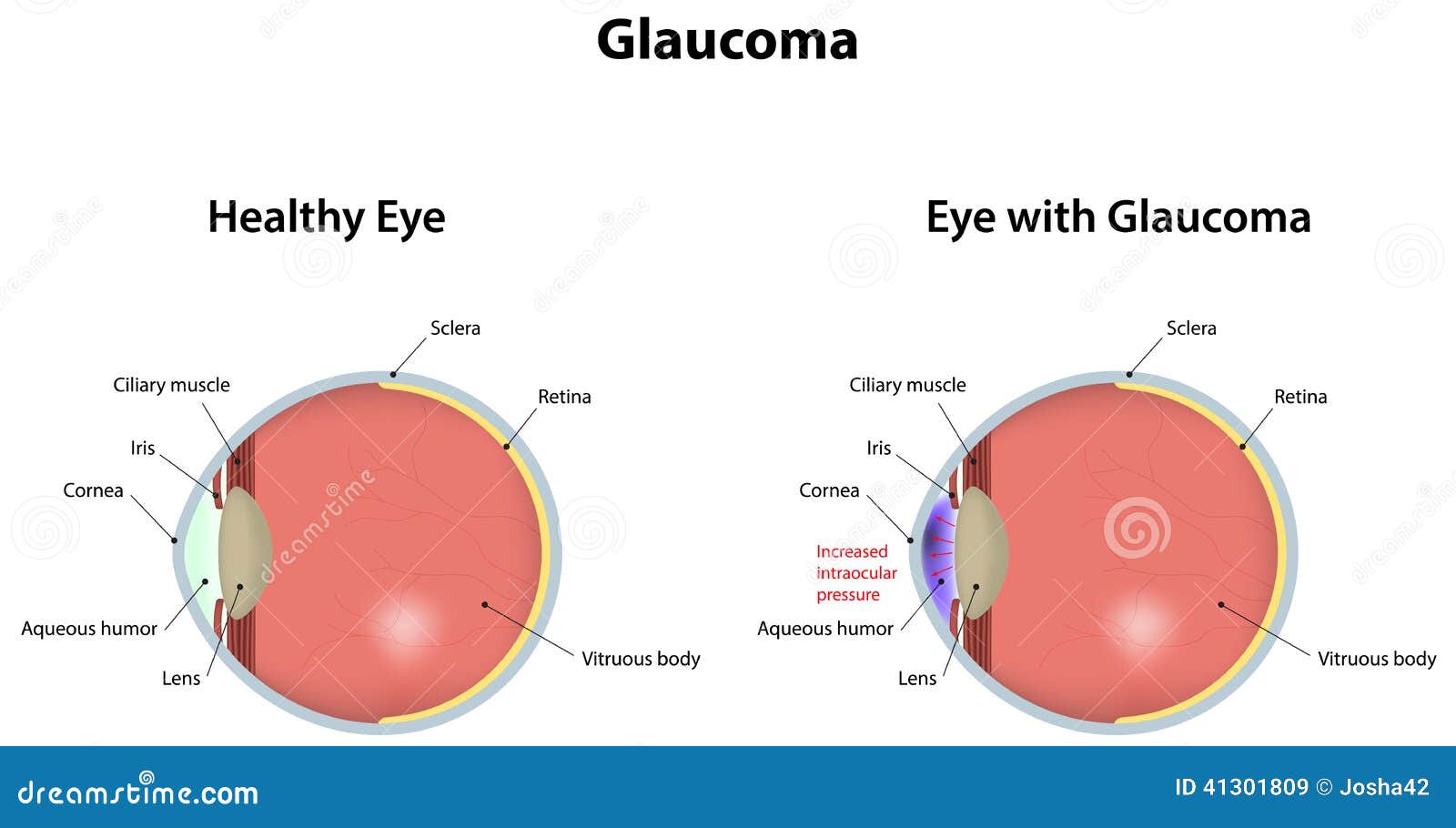Glaucoma stock vector. Illustration of cornea, pressure - 41301809