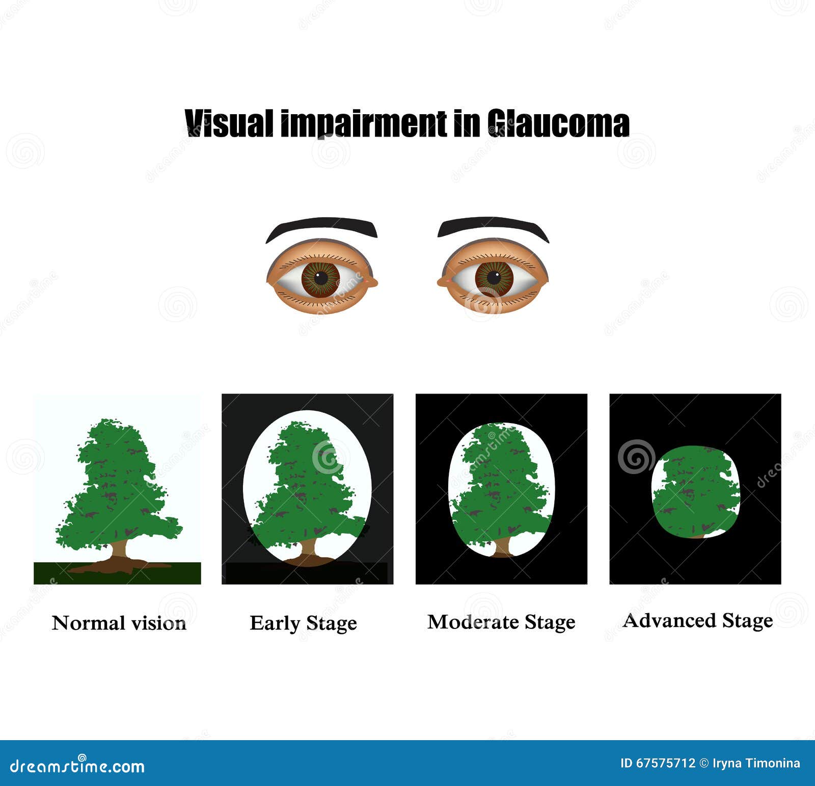 Glaucoma. The Field Of Vision In Glaucoma. Infographics. Vector ...