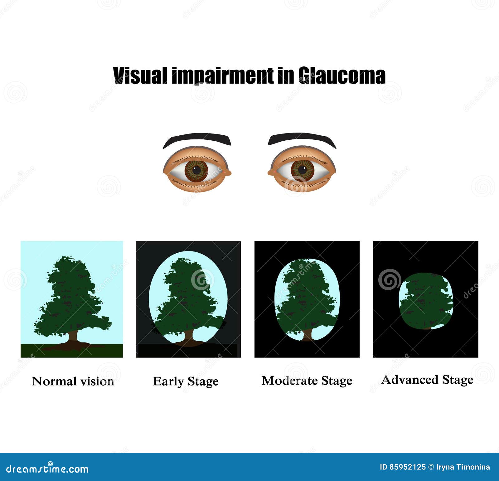 Glaucoma. The Field Of Vision In Glaucoma. Infographics. Vector ...