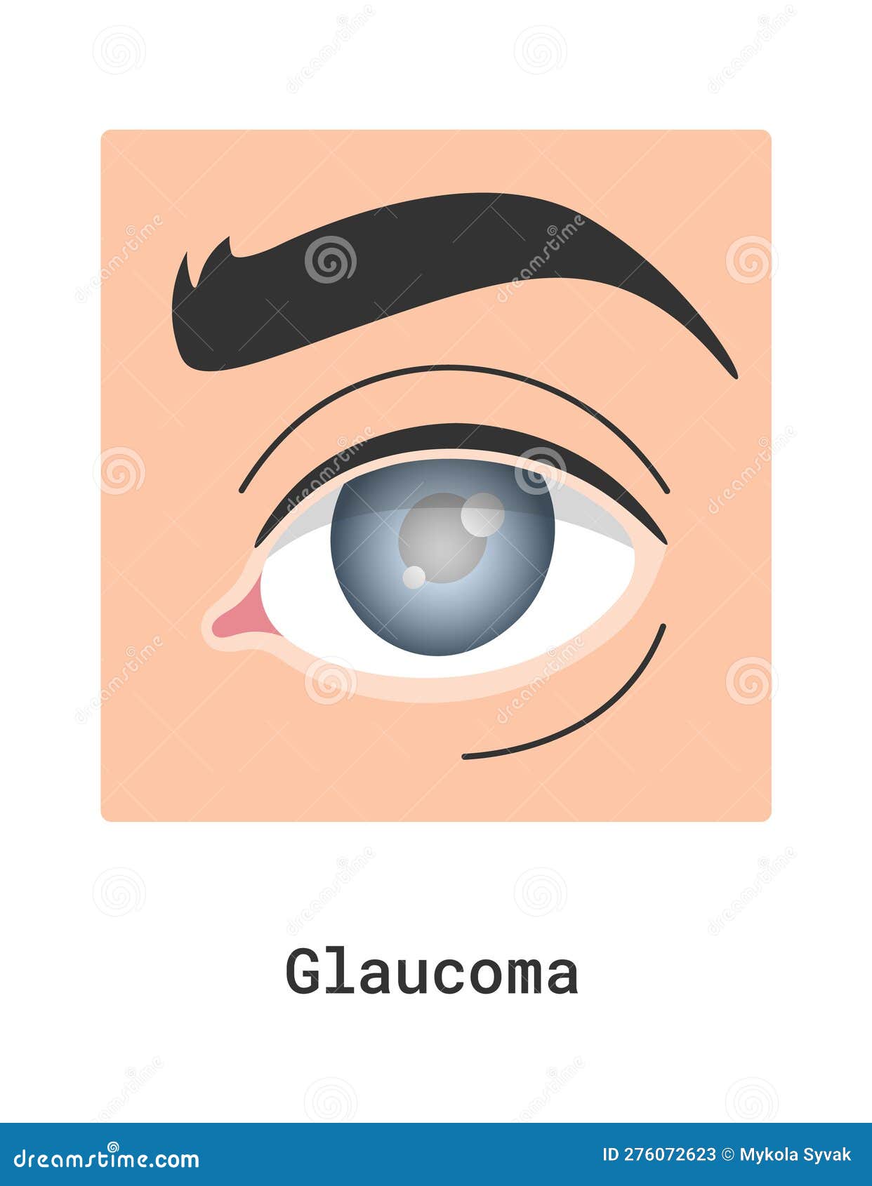 Glaucoma Human Eye Disease Vector Illustration | CartoonDealer.com ...