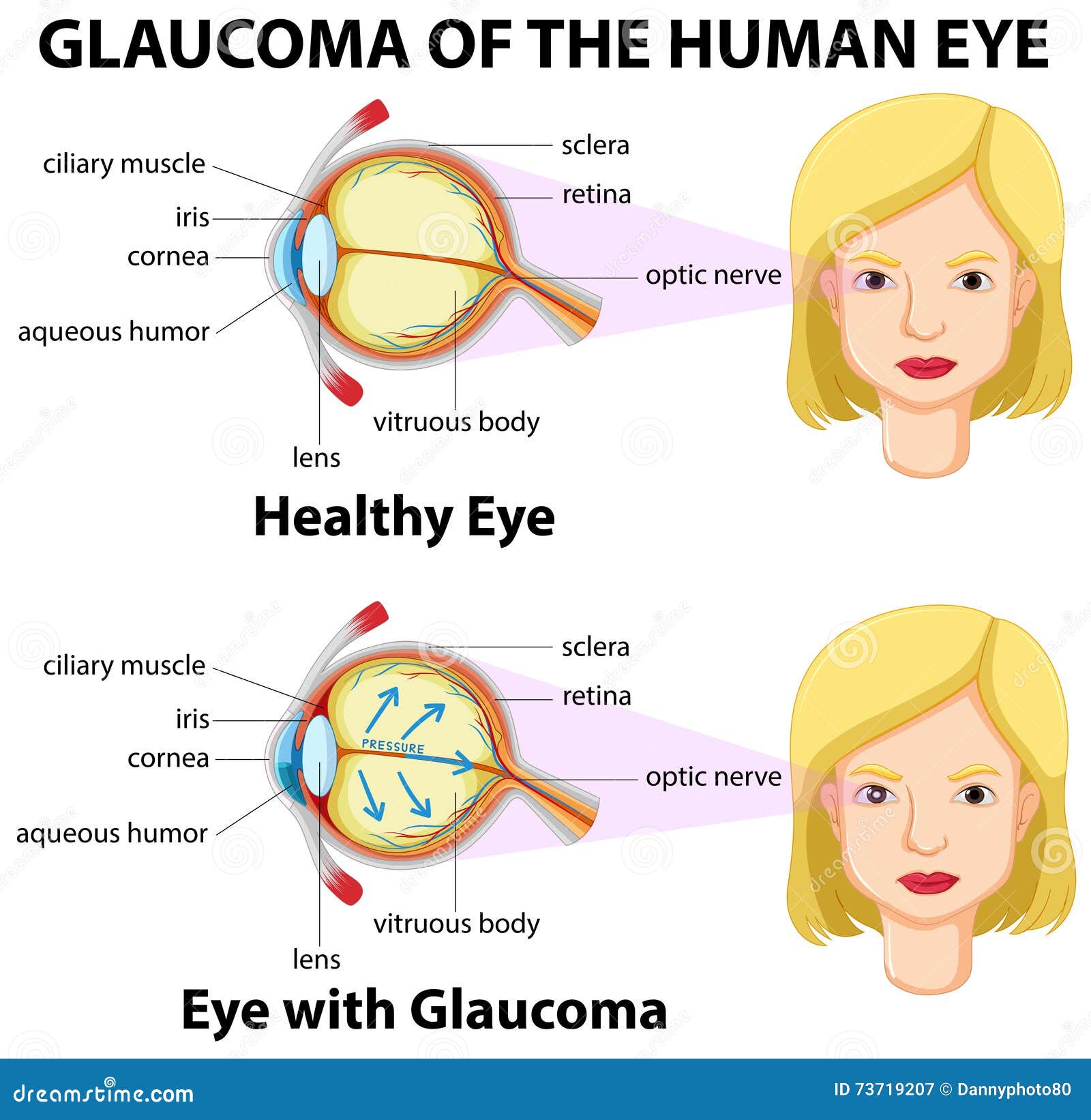 Glaucoma. Human Eye. Vector Sign For Web Graphics. | CartoonDealer.com ...