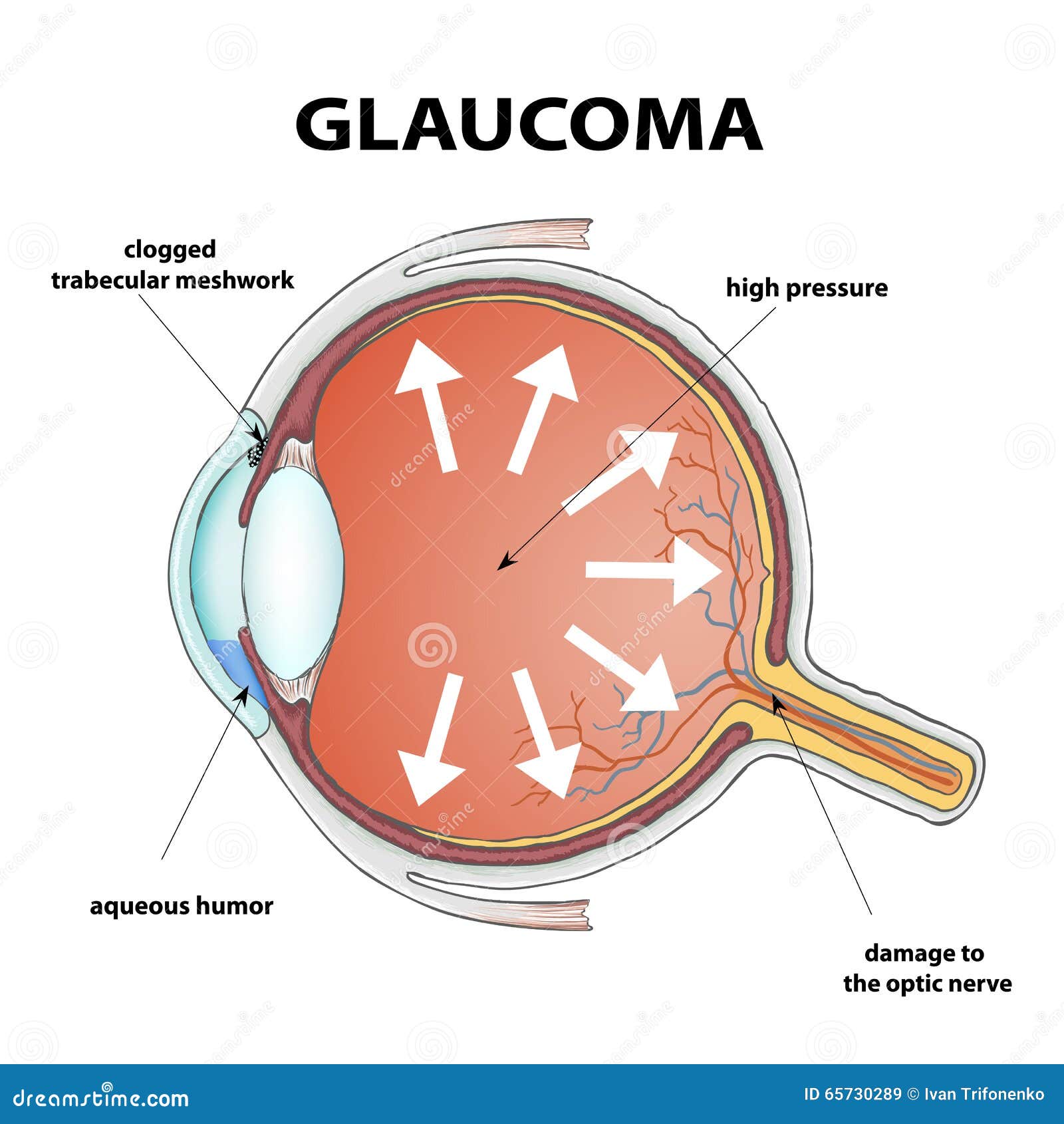 Glaucoma. Stock Illustration. Stock Vector - Illustration of blindness ...