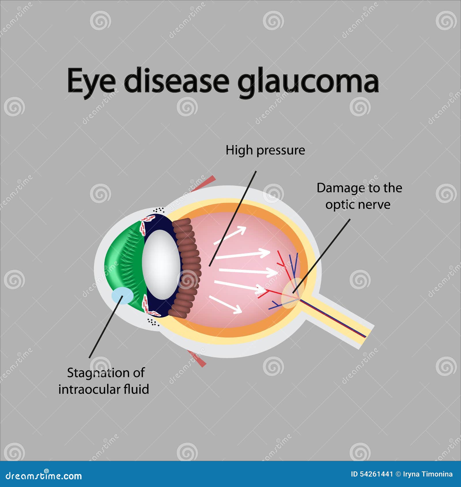Glaucomatous Eye. Violations Causing Glaucoma Cartoon Vector ...