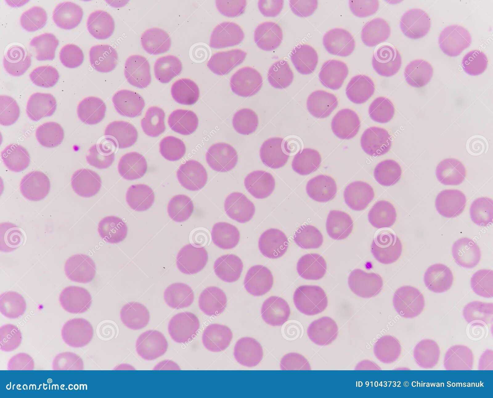 Globuli Rossi Normacytic Di Normochromic Fotografia Stock - Immagine di ...