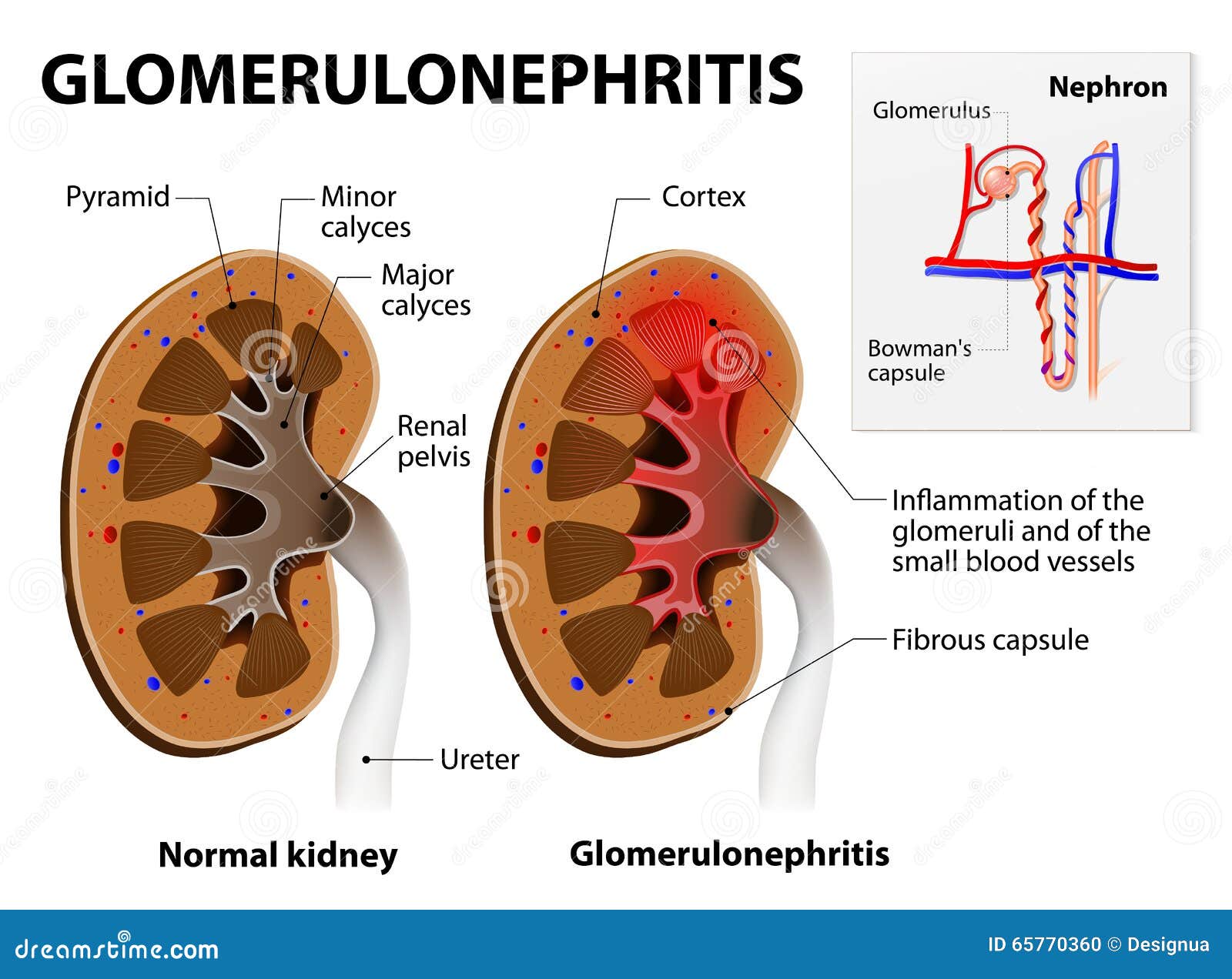 Glomerulonephritis Eller Glomerular Nefrit Njursjukdom Vektor ...