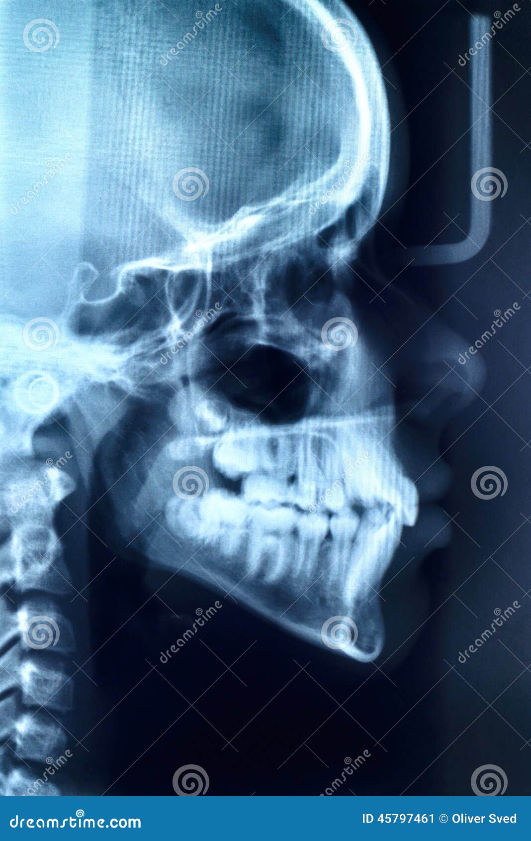 Glowing and Radiant MRI Scan Stock Image - Image of film, head: 45797461