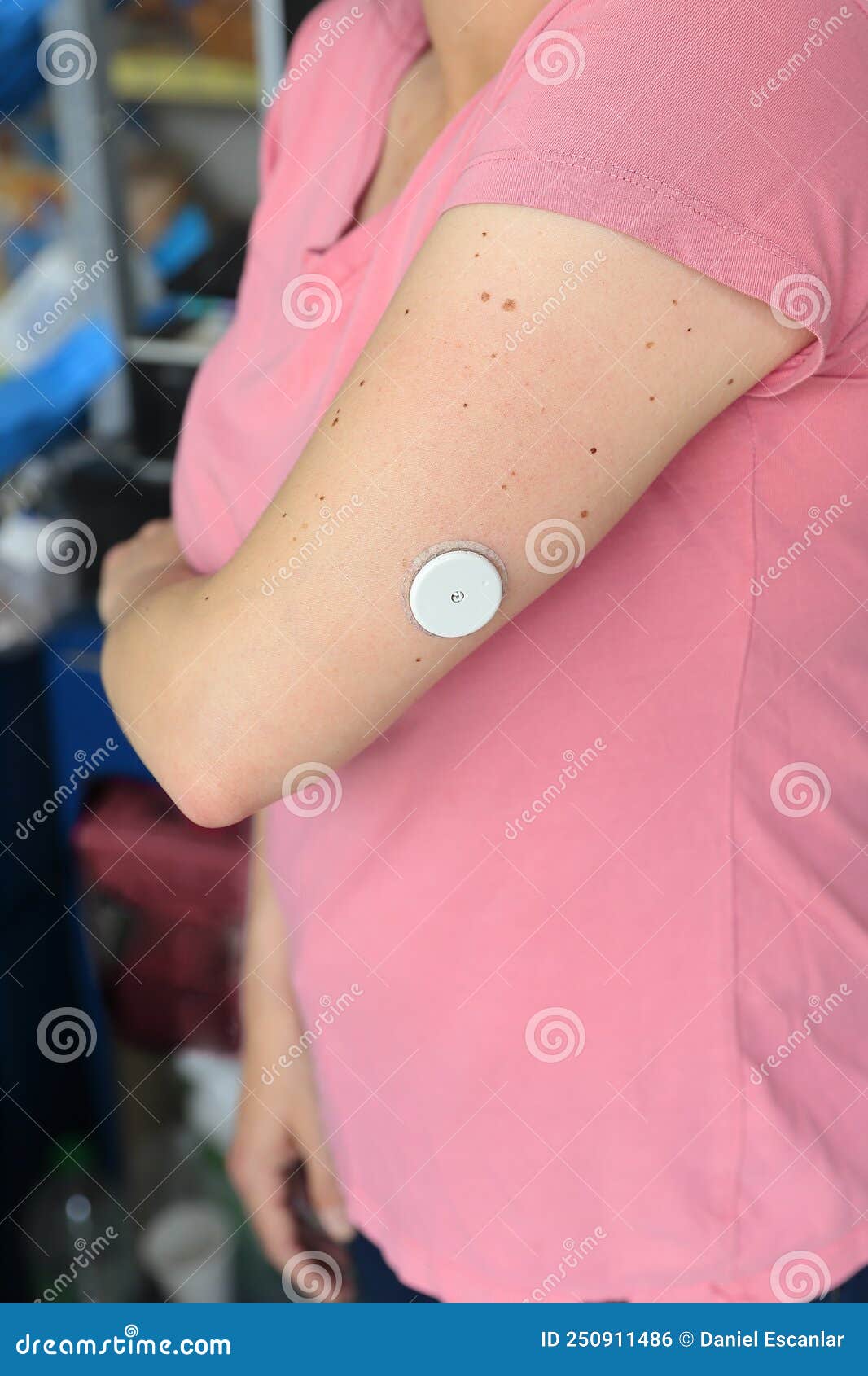 Glucose Sensor Implanted in the Arm of a Working Woman Stock Photo ...