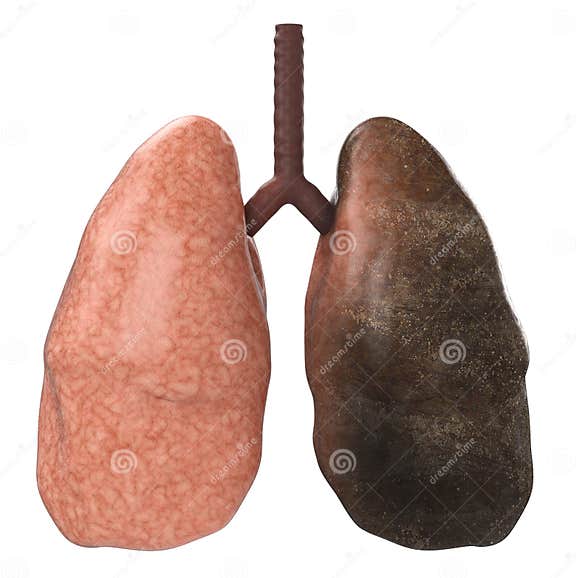 Goede en slechte longen stock illustratie. Illustration of emfyseem ...