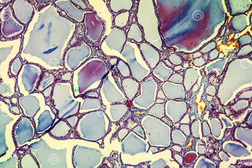 Goiter with Colloid Thyroid Disease Stock Image - Image of colloid ...