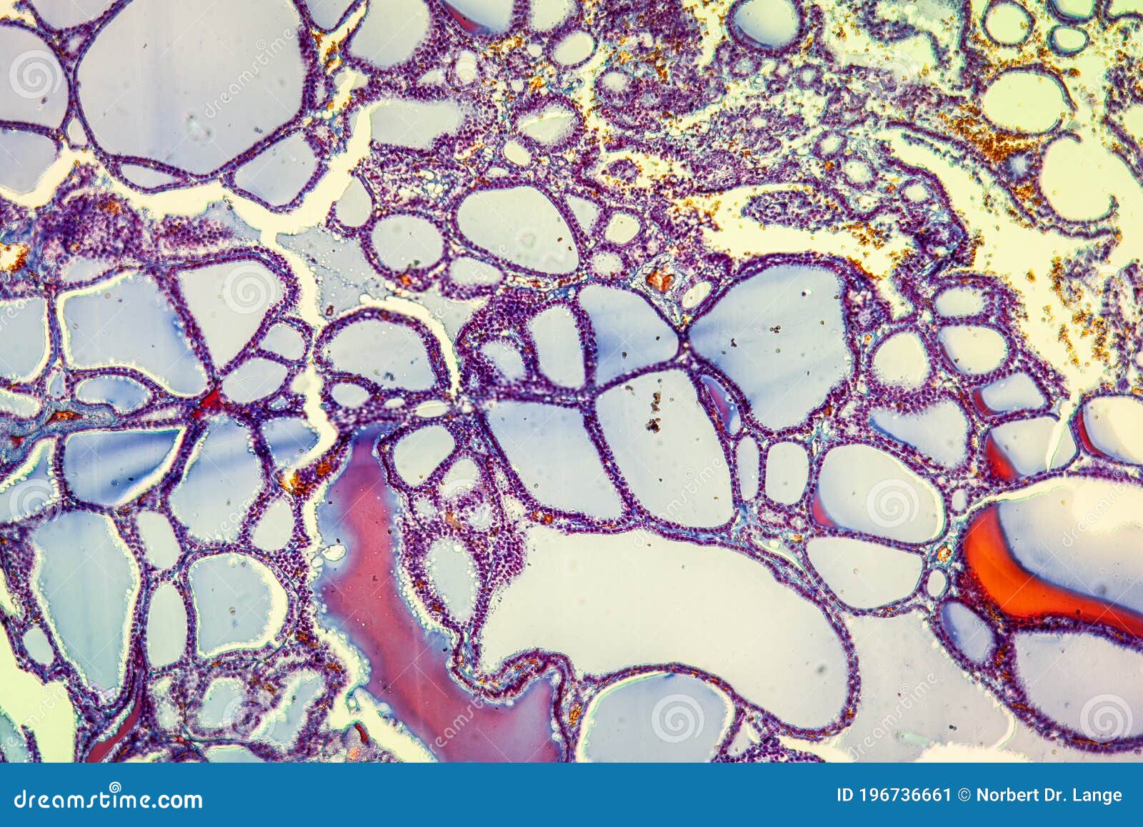 Goiter With Colloid Thyroid Disease Stock Image | CartoonDealer.com ...