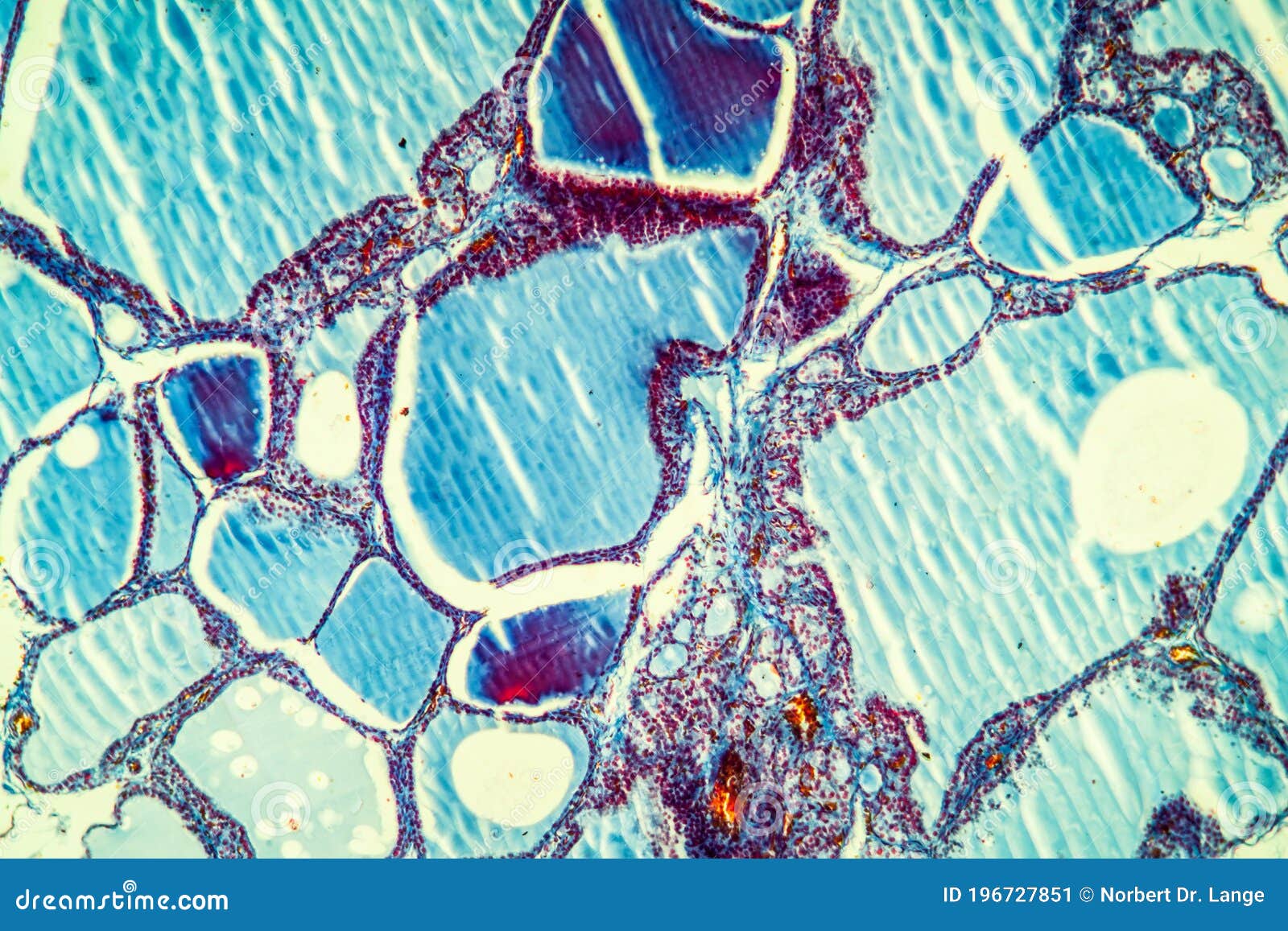 Goiter Thyroid Tissue with Colloid Stock Image - Image of macro, glass ...