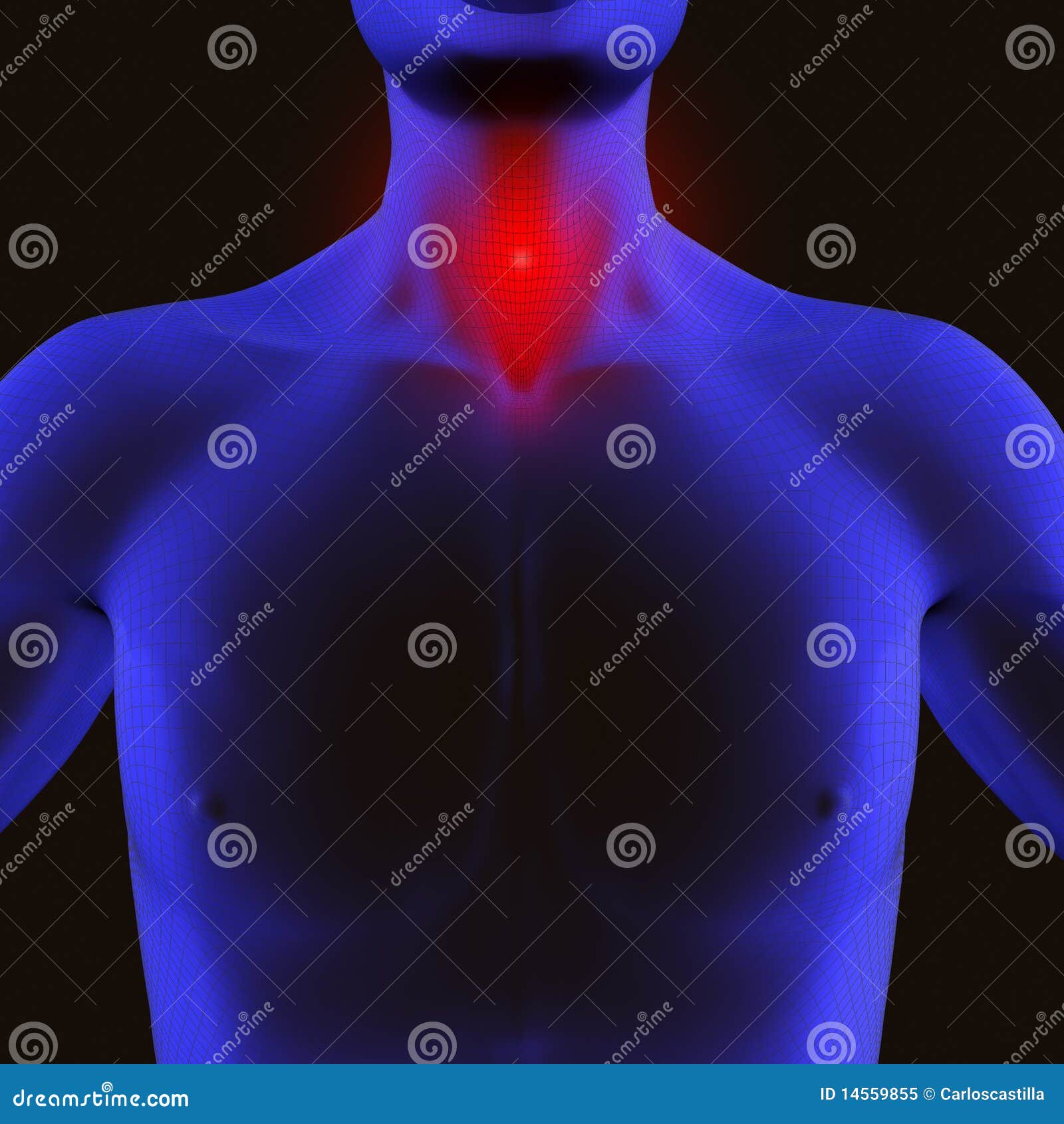 Gola irritata illustrazione di stock. Illustrazione di esofago - 14559855