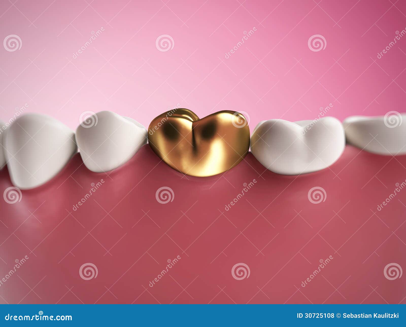 Gouden tand stock illustratie. Illustration of medisch - 30725108