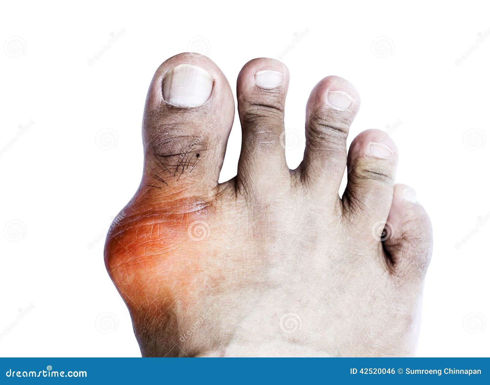 Gout do dedo grande do pé foto de stock. Imagem de medicina - 42520046