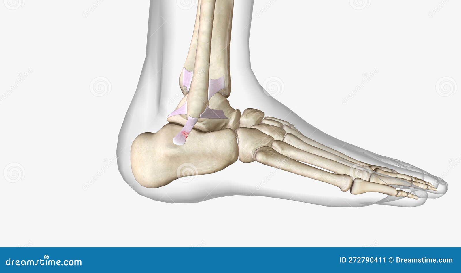 Ankle Sprain Diagram With Torn Ligaments Medical Cartoon Vector ...