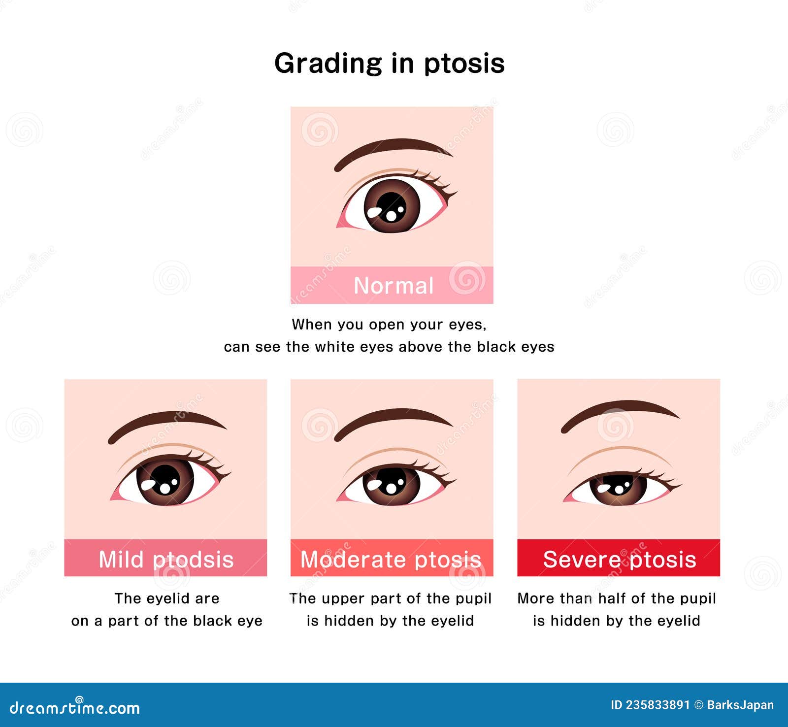 Grading in Ptosis Vector Illustration Stock Vector - Illustration of direction, change: 235833891
