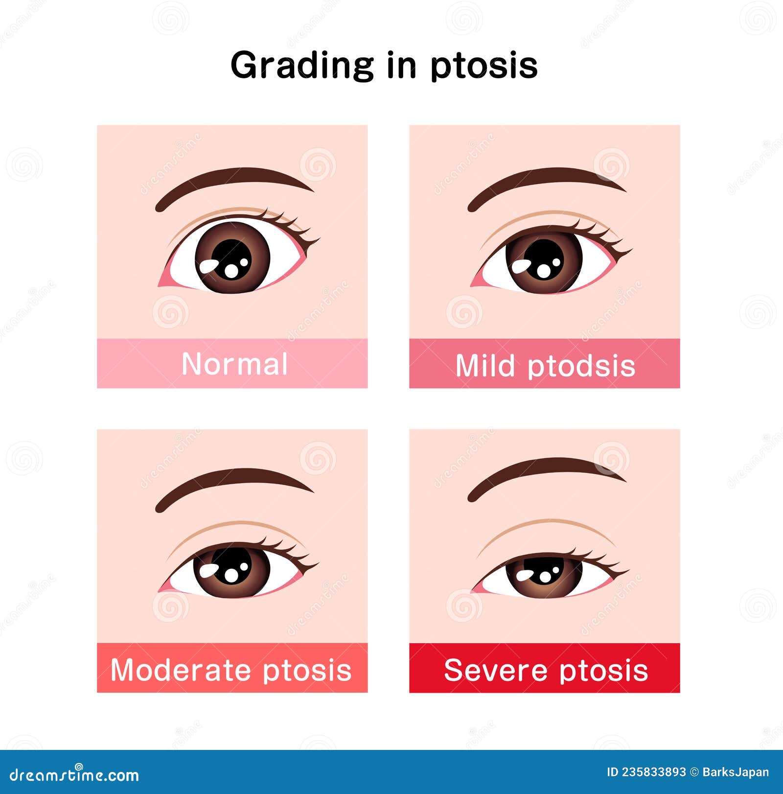 Grading in Ptosis Vector Illustration Stock Vector - Illustration of ...
