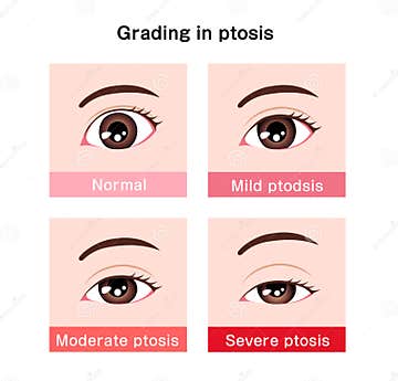 Grading in Ptosis Vector Illustration Stock Vector - Illustration of ...