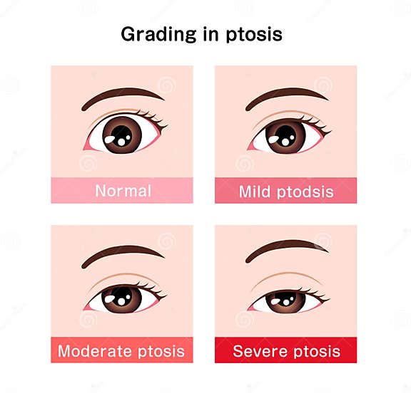 Grading in Ptosis Vector Illustration Stock Vector - Illustration of ...