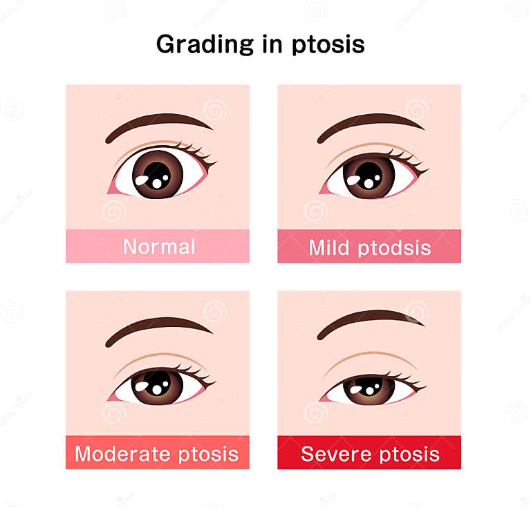 Grading in Ptosis Vector Illustration Stock Vector - Illustration of ...